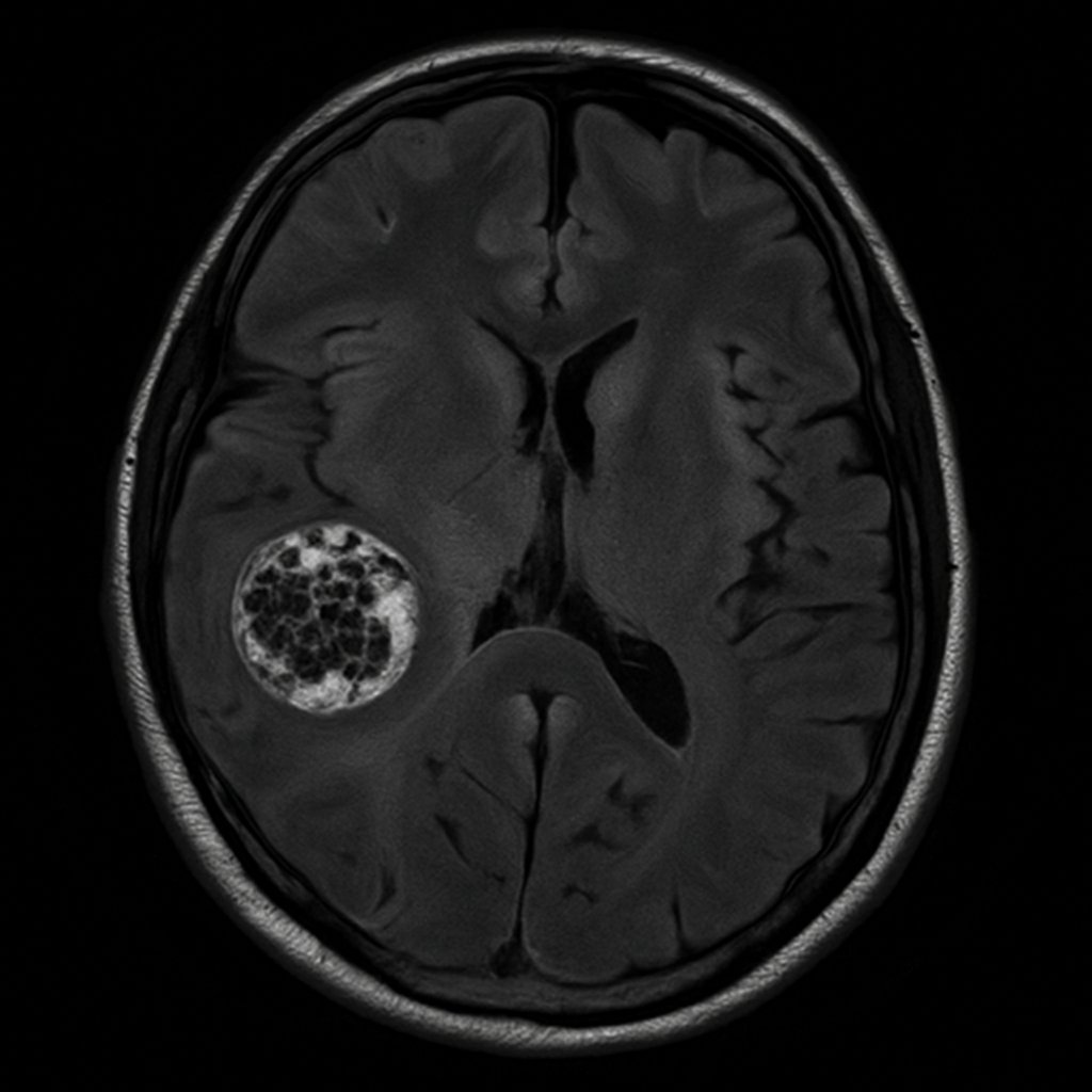 Cavernomas Cerebrales: Causas, Diagnóstico y Tratamiento | Dr. Kevin ...