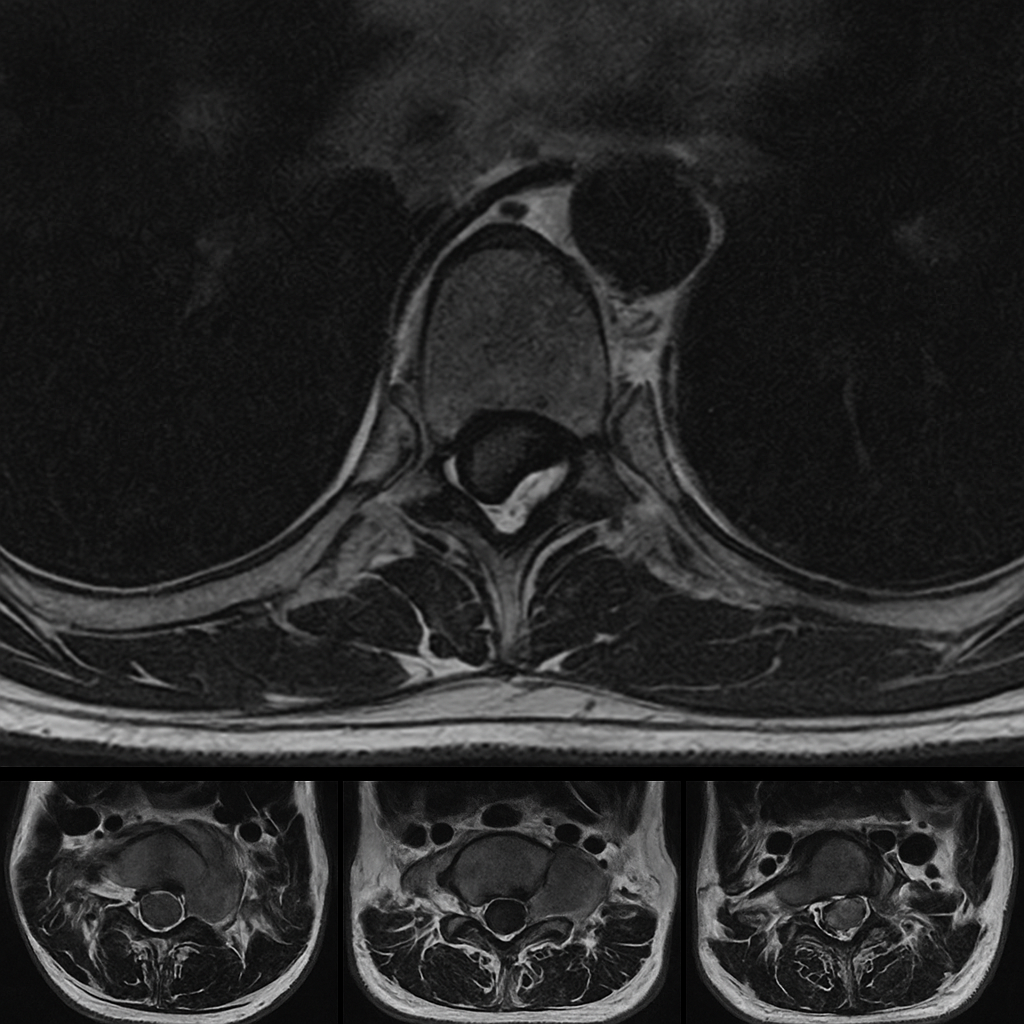 Hernia Discal Dorsal: Causas, Síntomas y Tratamiento | Dr. Kevin Armas ...